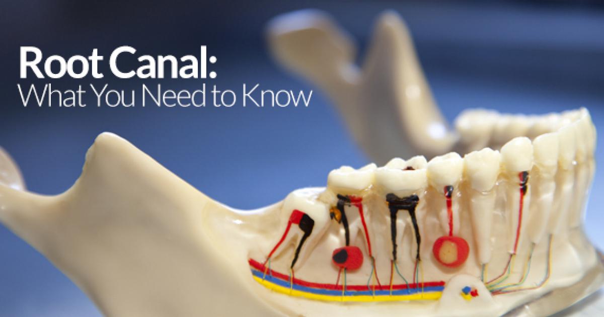 Root Canal - What You Need to Know